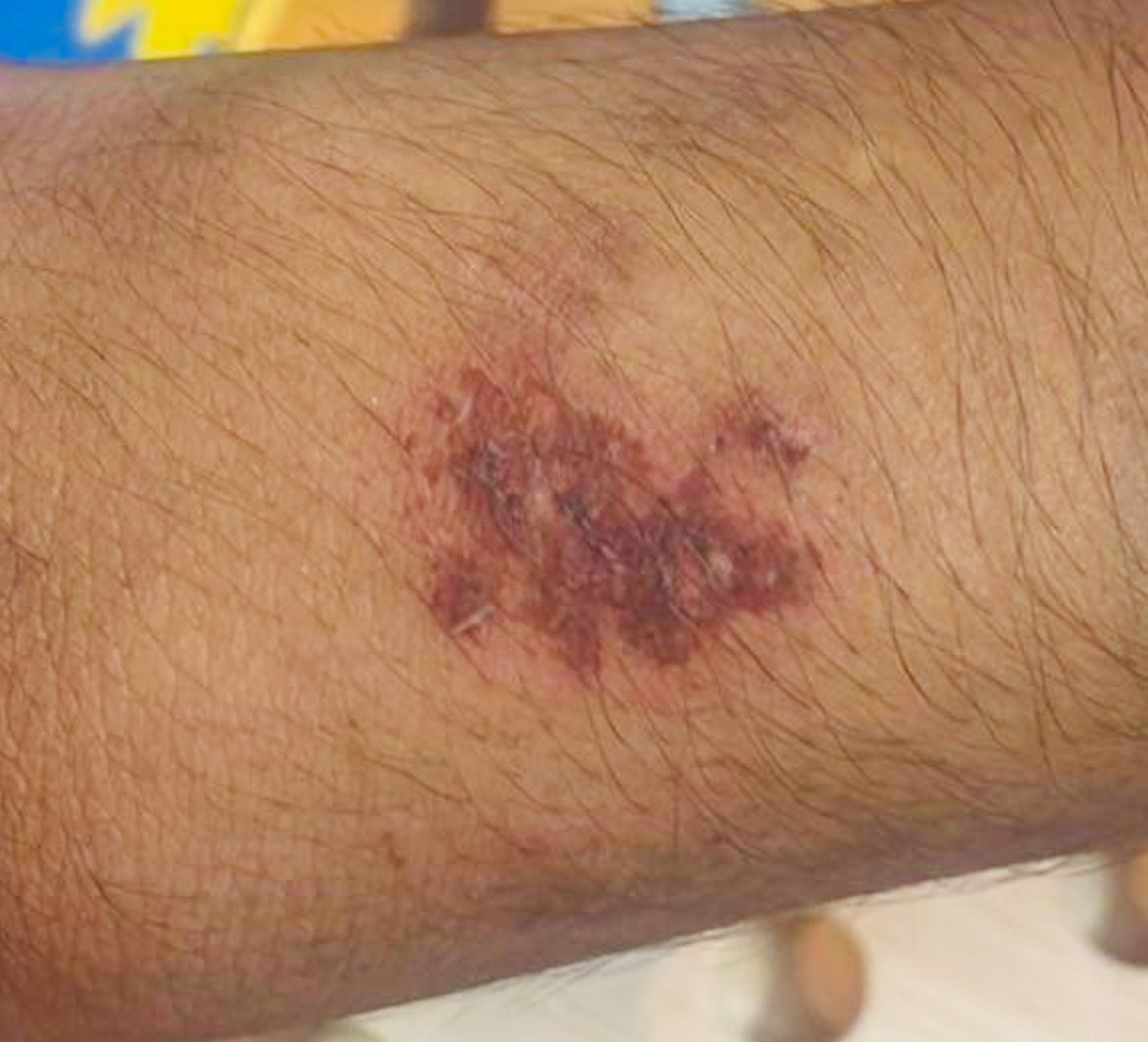 Skin Disorder Hay fever Food Sensitivity Allergy – Shahmika Agoon